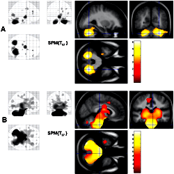 Voxel-based morphometry (VBM) findings.