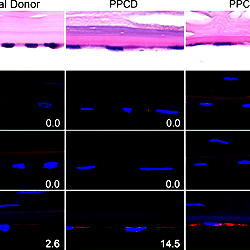Detection of OVOL2, CCM2L and THBD in normal donor and PPCD corneal ...