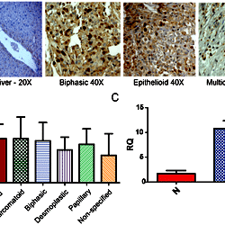 Human MMs express FOXM1.