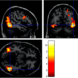 Regions of BOLD activation during the contrast negative visual ...
