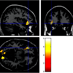 Regions of BOLD activation during the contrast negative verbal ...