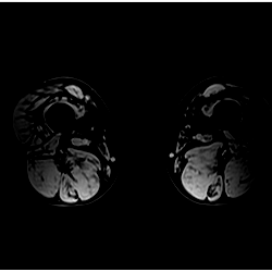 Muscle MRI imaging of the index case showing slight atrophy in the ...