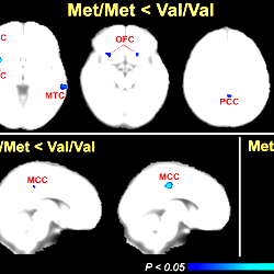 VBM differences among three genotypes based on the BDNF Val66Met ...
