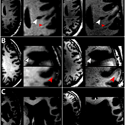 Comparison of T1-weighted images derived from T1-MPRAGE at 3 T and 7 T.