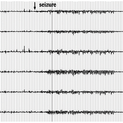 Simultaneously recorded EEG from Fp1, Fp2, F3, F4, C3 and C4 electrodes.
