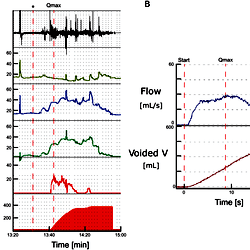Pathological findings during pressure flow study.