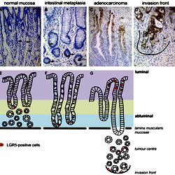 Staining patterns of LGR5 in gastric cancer tissues.
