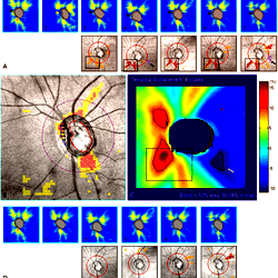 Interpretation of optic disc center displacement in Guided Progression ...