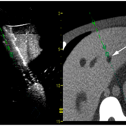 Image fusion of the CT and B-Scan of the liver phantom used in our ...