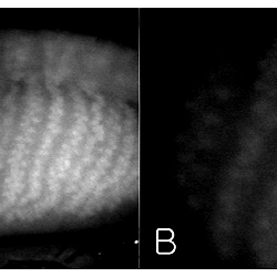 Item - The meibomian glands of the left upper lid of the subject A by ...