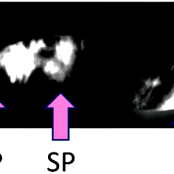 ICG lymphography findings in Case 3.