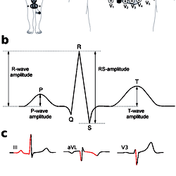 Illustration of ECG waves and values.
