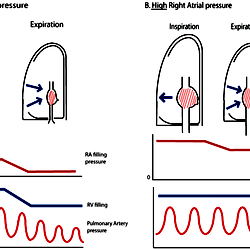 Schematic illustration of the effect of similar intrathoracic pressures ...