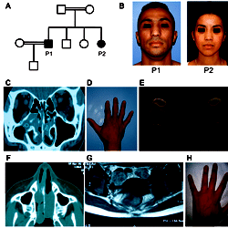 Clinical and radiological data of the patients P1 and P2.