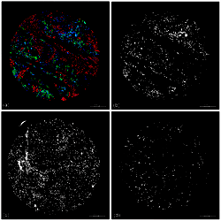 Microscopic image examples of different TMA-cores.