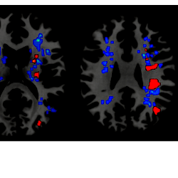 MRI lesion distribution of 37 patients using SPM.
