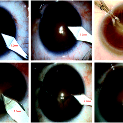 The different sizes of clear corneal incisions for phacoemulsification ...