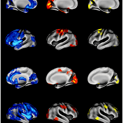 Surface renderings representing the results from the analysis of MRI data.