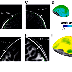 Whole-brain calculation of brain-scalp distance.