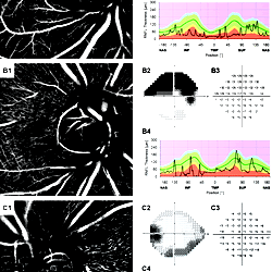 Ten-frame averaged OCTA, Humphrey visual fields with total deviation ...