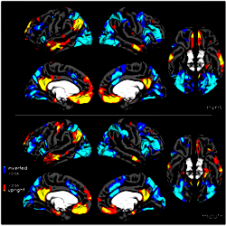 Areas of significant activations in the analysis of upright vs ...