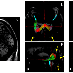 DTI fiber tracking images of the splenium of the patient and a normal ...