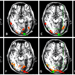 fMRI activation maps for two presentation conditions in the patient.