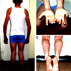 Clinical characterization of the CMT2A patient harboring the p ...