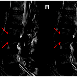 Type III Modic changes in lumbar spine.