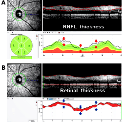 The similar profiles of RNFL thickness and retinal thickness change in ...