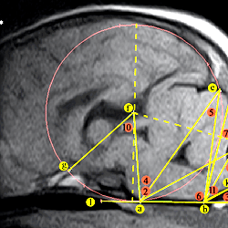 24 measurements used to map the hindbrain and craniocervical junction ...