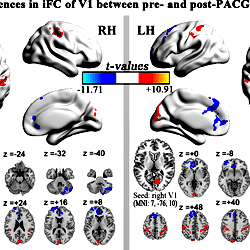 Alteration of iFC of V1 between the pre-PACG and post-PACG patients.
