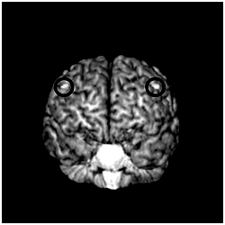 Targeting the Dorsolateral Prefrontal Cortex (DLPFC) for rTMS stimulation.