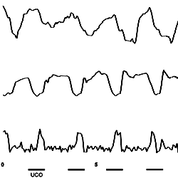 Representative segments of correlated changes in fetal heart rate ...