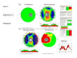 Optic Nerve Head Maps and GCC Significance Maps from RTVue Optical ...