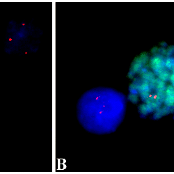 Example of Immuno-FISH performed on cells from patient no. 2.