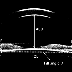 Measurement of the anterior chamber depth (ACD) and intraocular lens ...