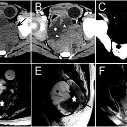 Presacral Region pPNET in a 5-year-old Female (Case no. 3).