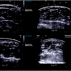 Ultrasound findings of the dcSSc patients and the control’s right ...