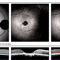Schematic and representative images of measurements in fundus ...