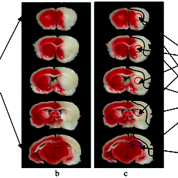 Brain infarction revealed by triphenyltetrazolium chloride (TTC) staining.