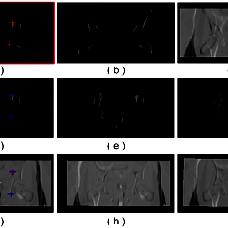 Coarse registration between EBRT and HDR-BT CT images for better ...