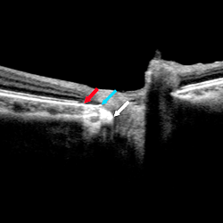 Identification of the beta zone and the gamma zone in a B-scan image.