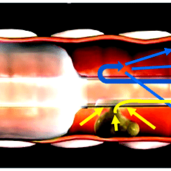 Subglottic secretions drainage based on rinsing and suctioning.