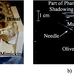 Ribs phantom as a clinical training tool for ultrasound guided kidney ...