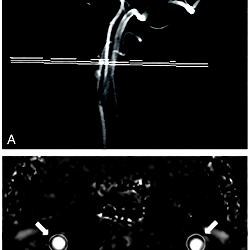 Single slice phase contrast MR angiography.