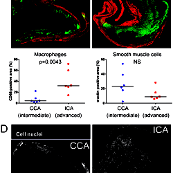 Plaques were intermediate in common carotid artery (CCA) and advanced ...