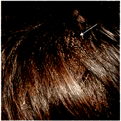 Heavily infested hair with Pediculus humanus capitis (arrow).