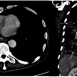 Primary pulmonary tuberculosis pattern with lobar consolidation.