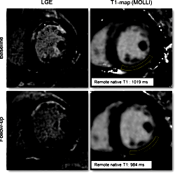 Typical location of the regions analyzed for T1 assessment.